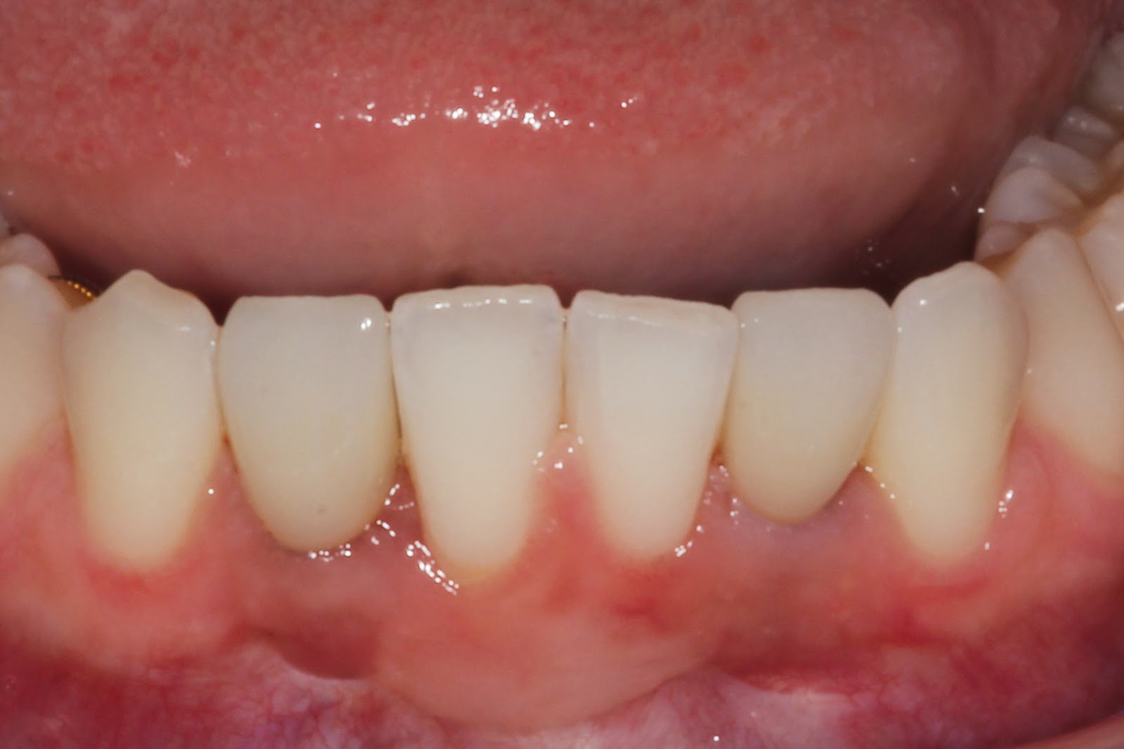 Boise Idaho Prosthodontics: Nobel Active 3 mm Custom Abutment Emax ...