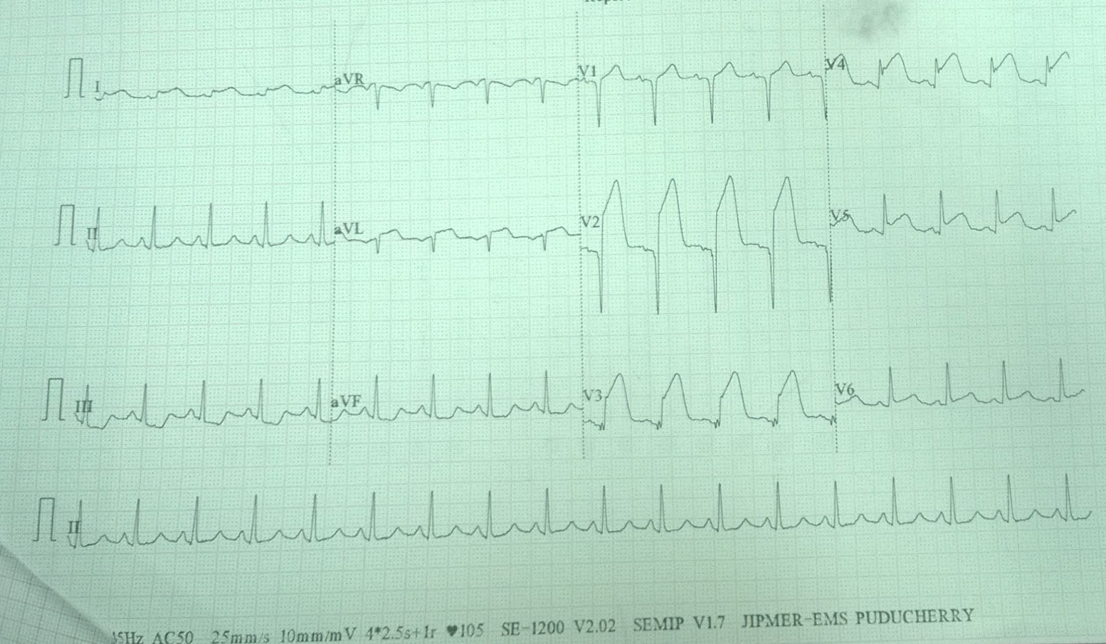 Cardiology window: Anterior wall myocardial infarction ECG