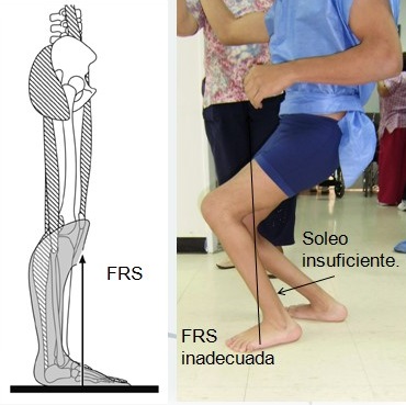 Parálisis cerebral - Cirugía de alargamiento de Isquiotibiales (Cuando ...