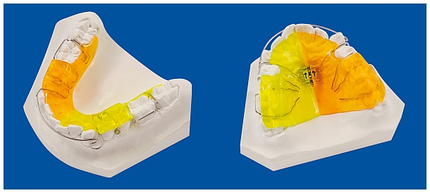 Ortho Lab Solution: Twin Block Appliance made by Ortho Lab Solution