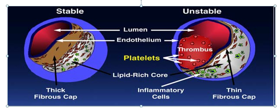 Medical Cardiology Heart Treatment: Pathogenesis of Acute Coronary ...