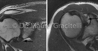 CAPSULITE ADESIVA (resumo de artigo cientifico )