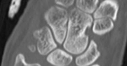 OCAD Tester Blog: Anatomy Question Re an Accessory Ulnar Wrist Ossicle