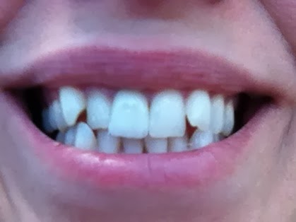 Michelle's Invisalign Journey