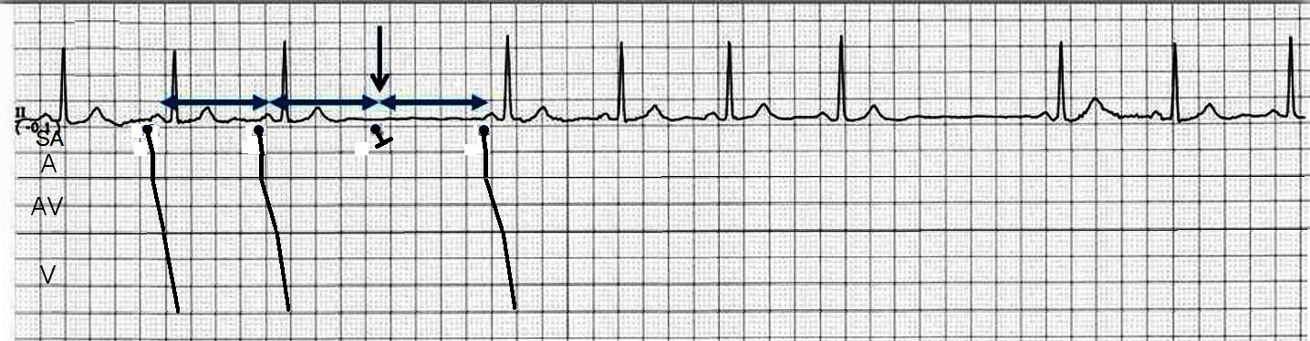 ECG Channel: Sinoatrial Block or Sinoatrial Exit Block