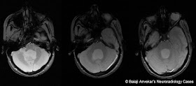 Dr Balaji Anvekar FRCR: Intraventricular Arachnoid cyst MRI