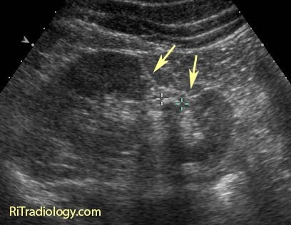 RiT radiology: Renal Scarring