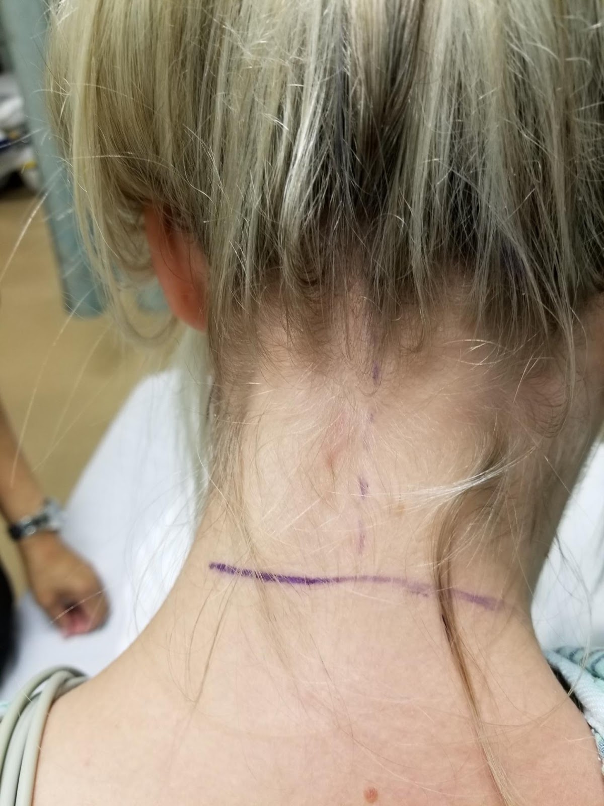 Migraine Surgery & Recovery | Perfectly Chaotic