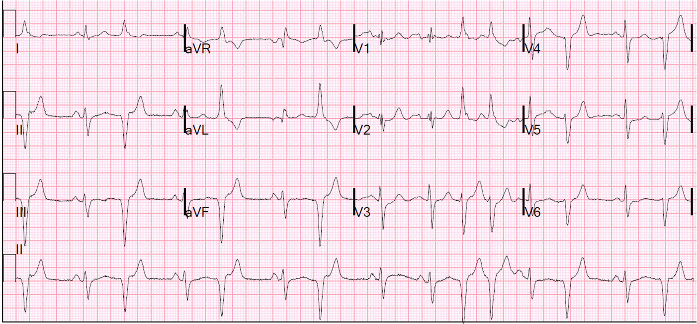 Dr. Smith's ECG Blog: Incessant Regular Wide Complex Tachycardia