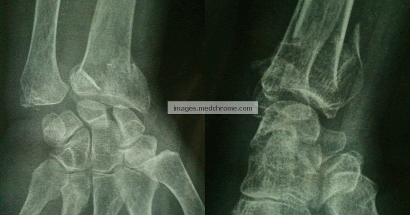 Barton's fracture | Medchrome Images
