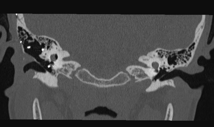 Cochlear implants and the Radiologist - Radiology Imaging