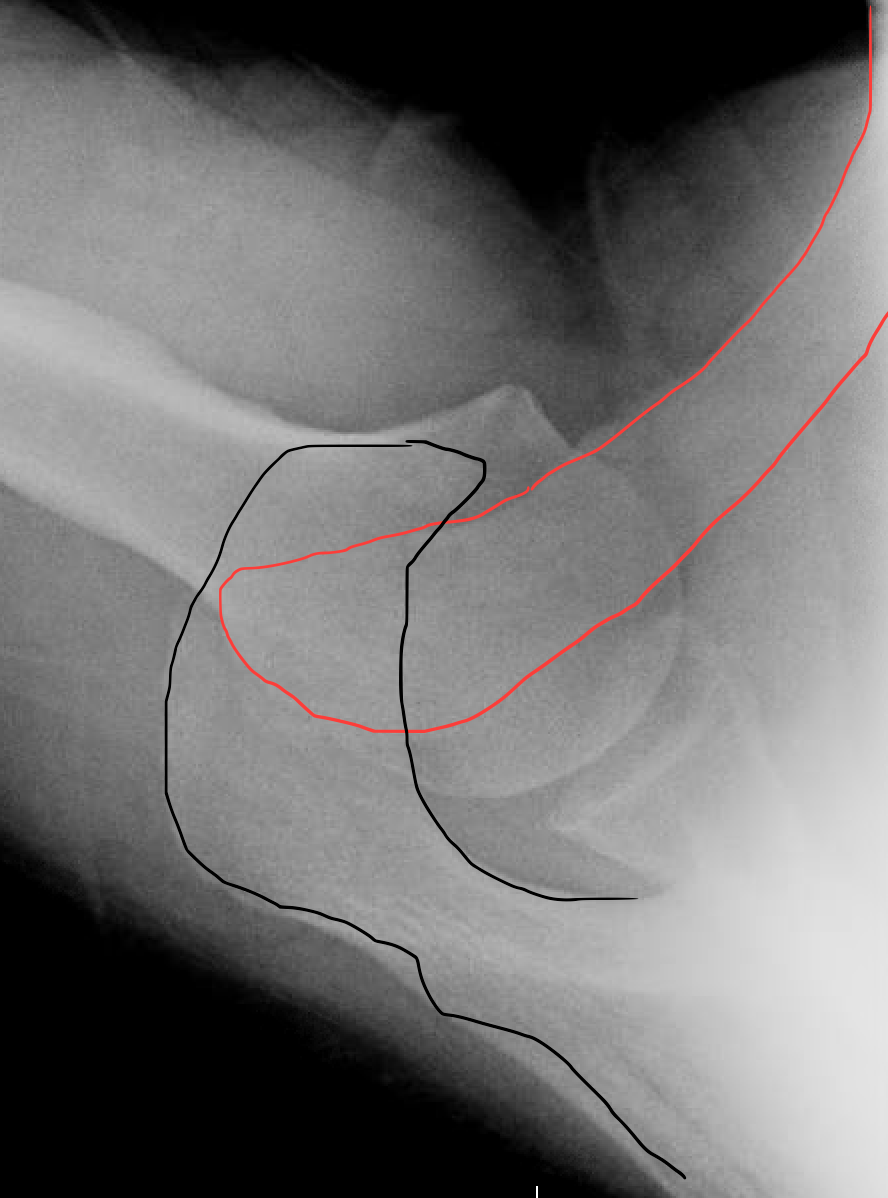 Shoulder and Elbow Surgery: Chronic AC joint separation ...