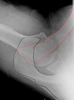 Shoulder and Elbow Surgery: Chronic AC joint separation ...