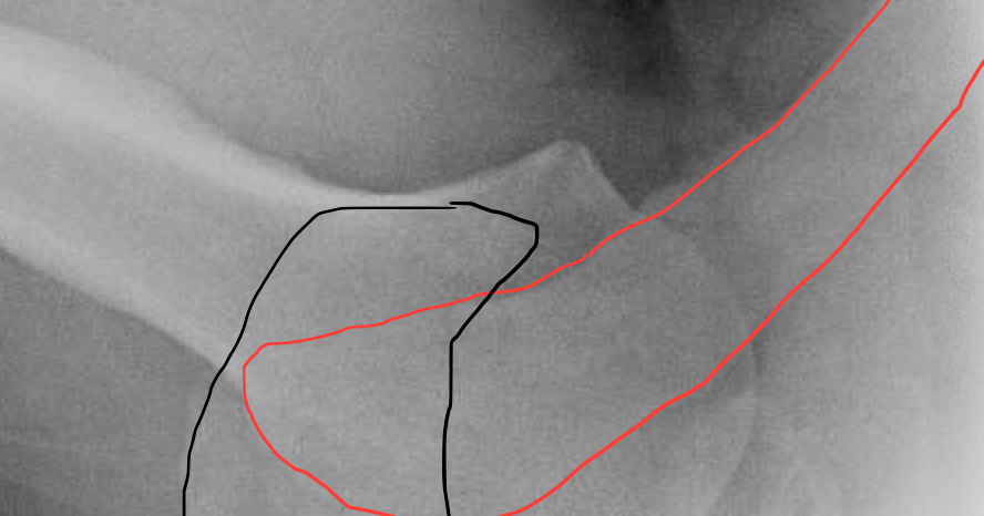 Shoulder and Elbow Surgery: Chronic AC joint separation ...