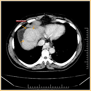 Hepatocellular carcinoma-CT - Radiology Imaging