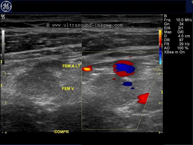 cochinblogs: Severe DVT of the lower limb