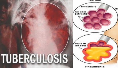 Mengetahui Gejala, Diagnosis, Dan Cara Pengobatan Penyakit TBC atau TB ...