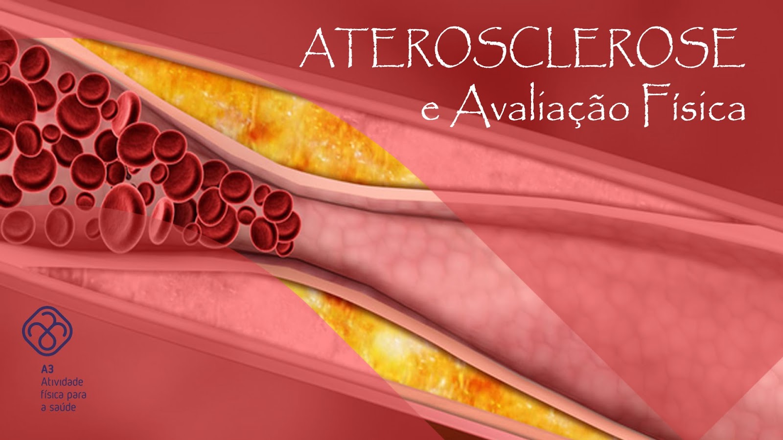 placa de ateroma - wood scribd braxin