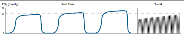 EM Didactic: Capnography beyond ROSC