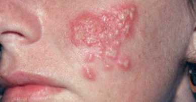 Causes, Diagnosis and Treatment of Impetigo - Treatment At Home