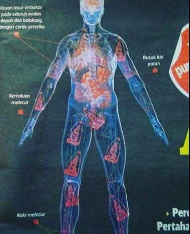 Gambaran NGERI Kesan Melecur Pada Badan Arwah Zulfarhan Osman ...