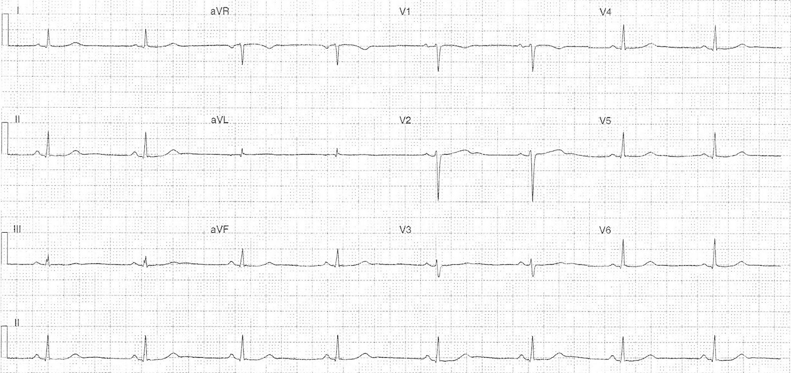 ECG of the Week: ECG of the Week - 9th October 2017 - Interpretation