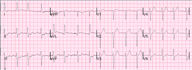 Dr. Smith's ECG Blog: Angiography can have bleeding complications - be ...