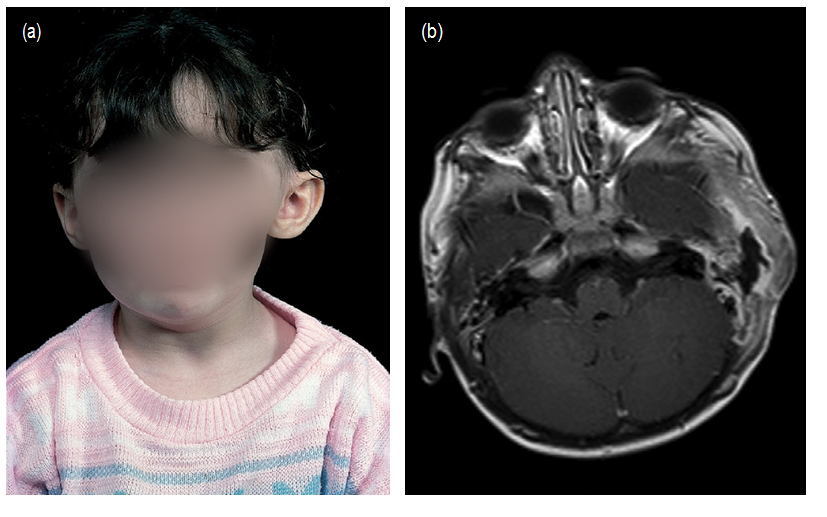 10-Complications of middle-ear infection - مدونة الدكتور حمدى زكريا الطبية