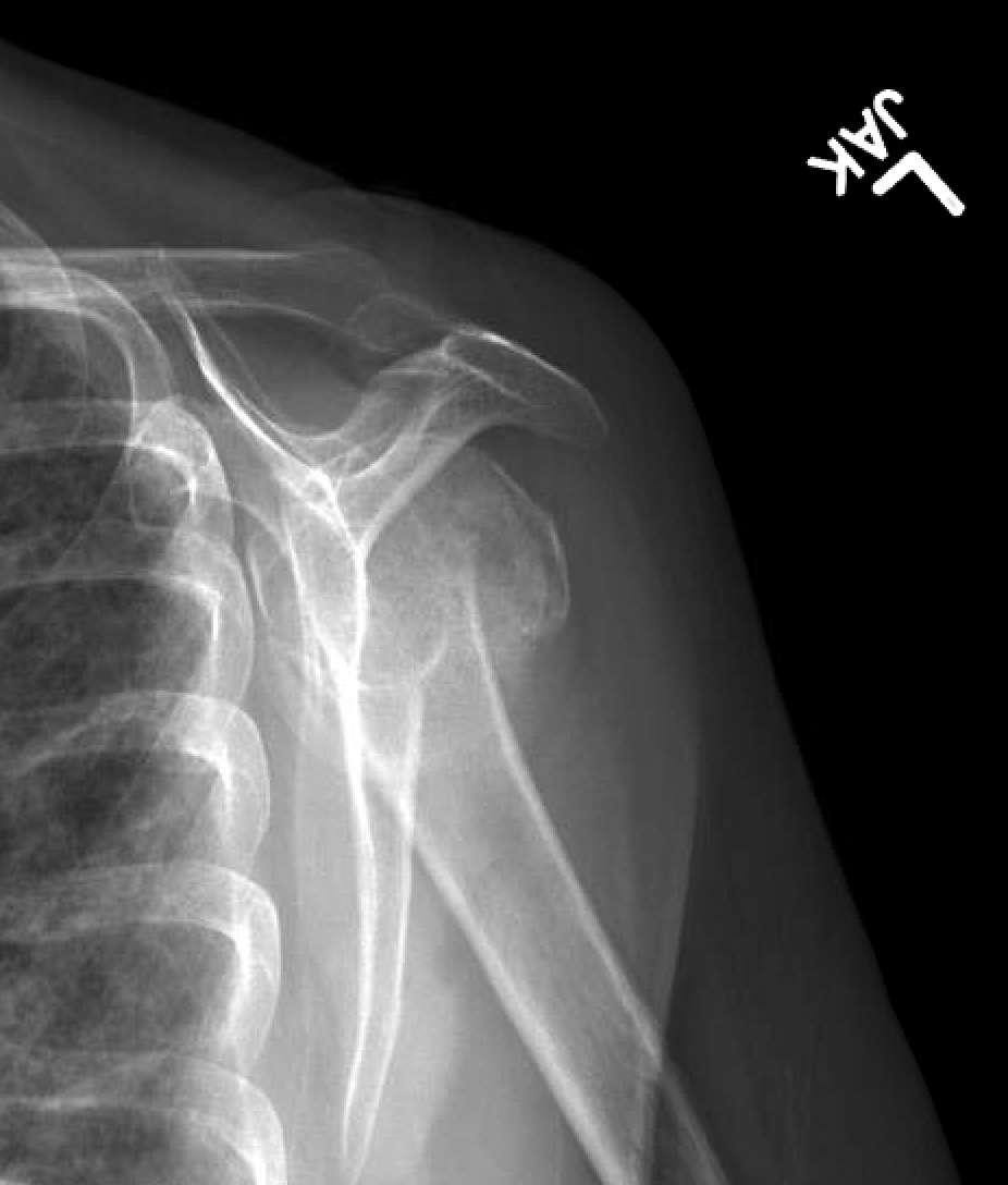 Shoulder and Elbow Surgery: Shoulder subluxation after proximal humerus ...