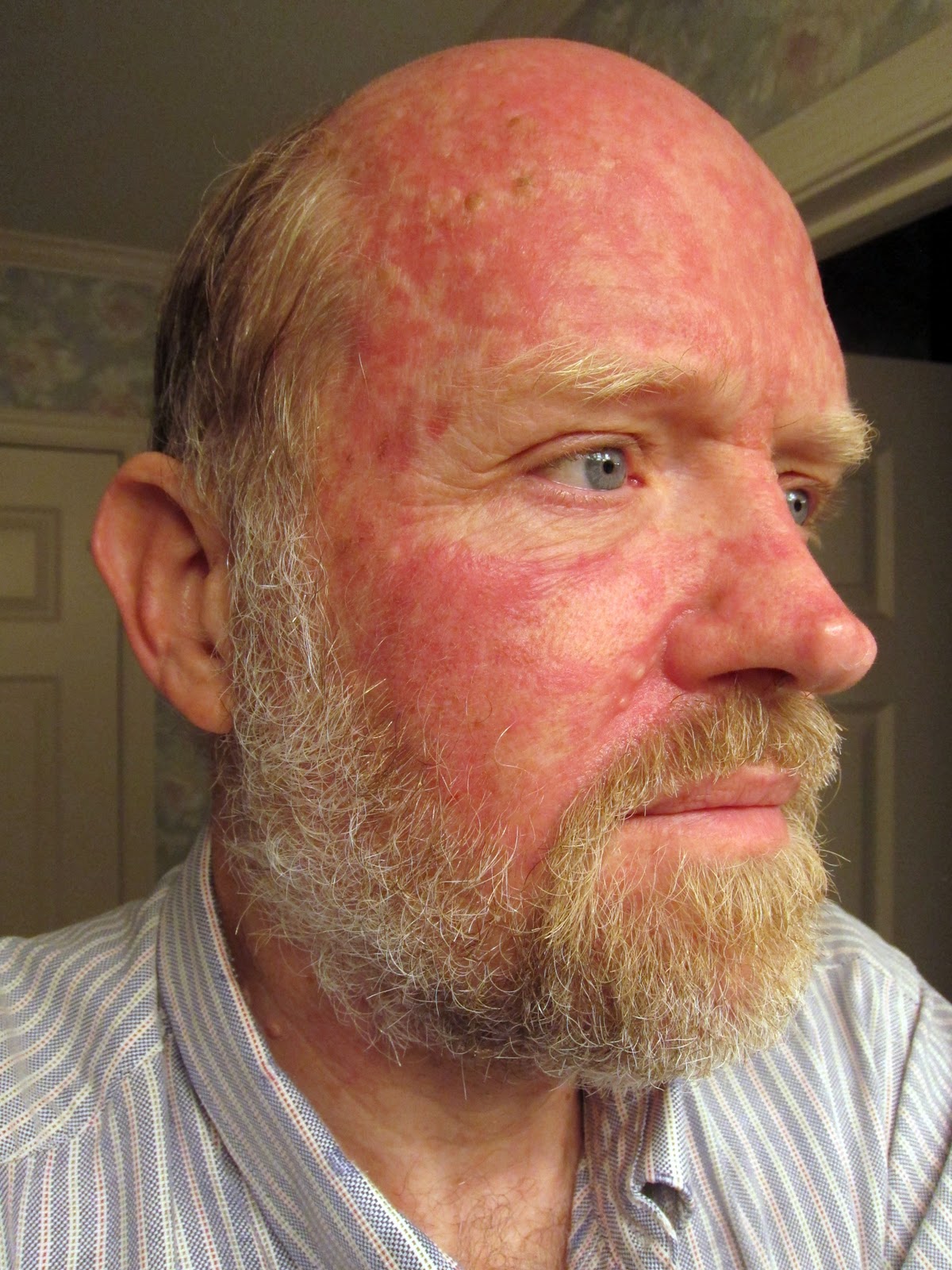 Efudex - Round Two: Day 20 (Recovery Day 6)