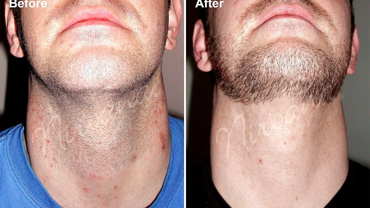 Laser Hair Therapy Side Effects Effect Choices