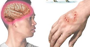 A short Intro to Rabies Pathophysiology and Treatment ~ Pharmacy Portal