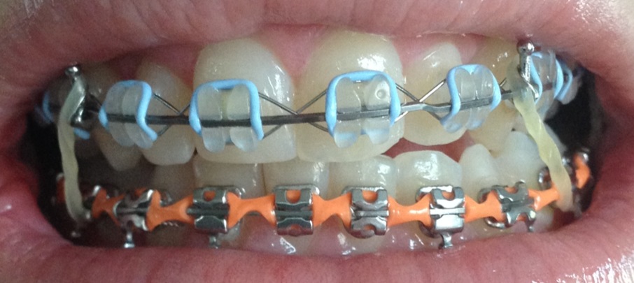 Braces Chick: Elastics and Polishing.