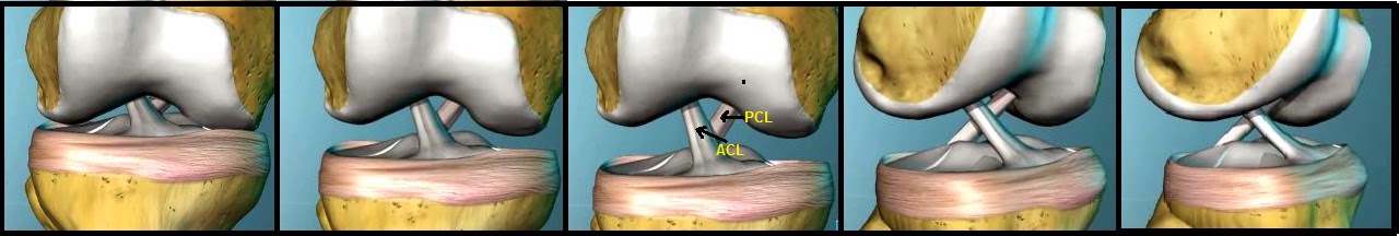 PART 2 - kecederaan Lutut ( Signs of a TORN ACL )