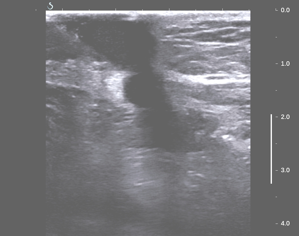 VIETNAMESE MEDIC ULTRASOUND: CASE 426: MULTIPLE TUBERCULOSIS ABSCESSES ...