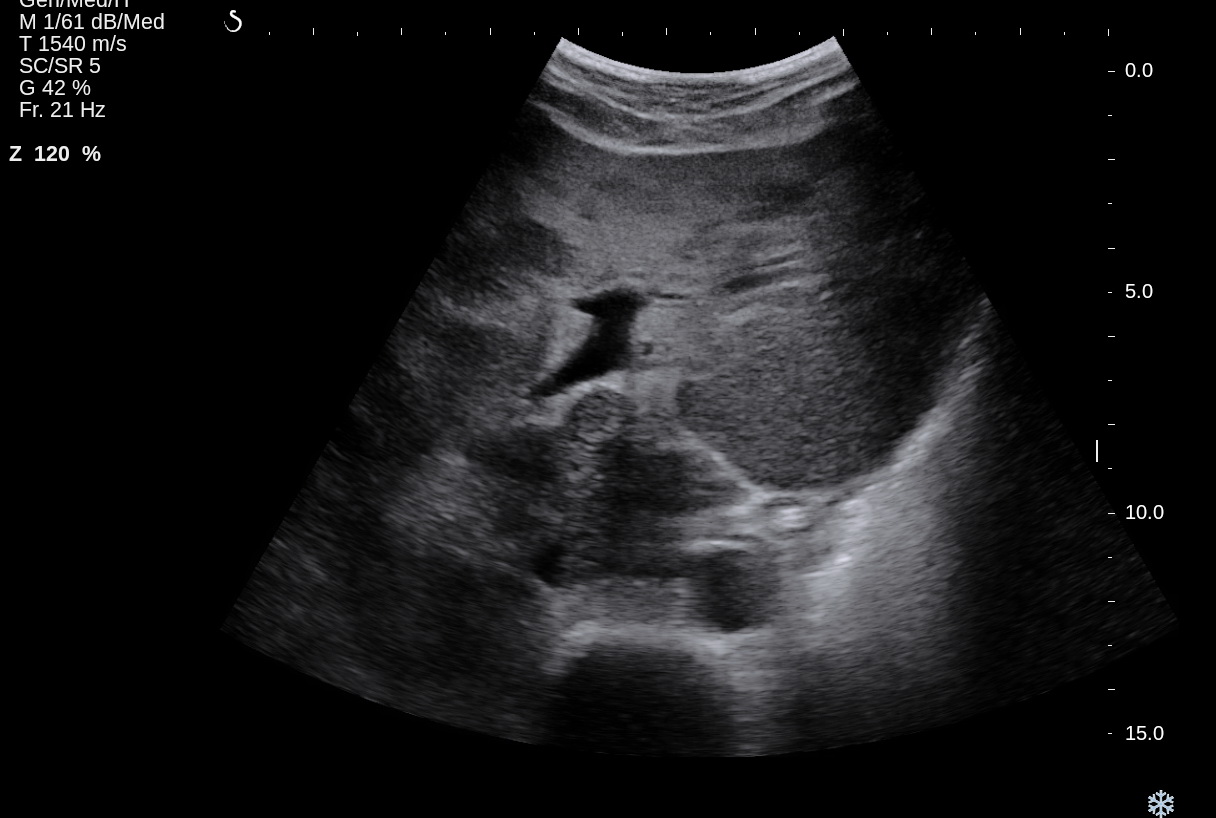 VIETNAMESE MEDIC ULTRASOUND: CASE 494: PRIMARY LIVER LYMPHOMA (PLL),Dr ...