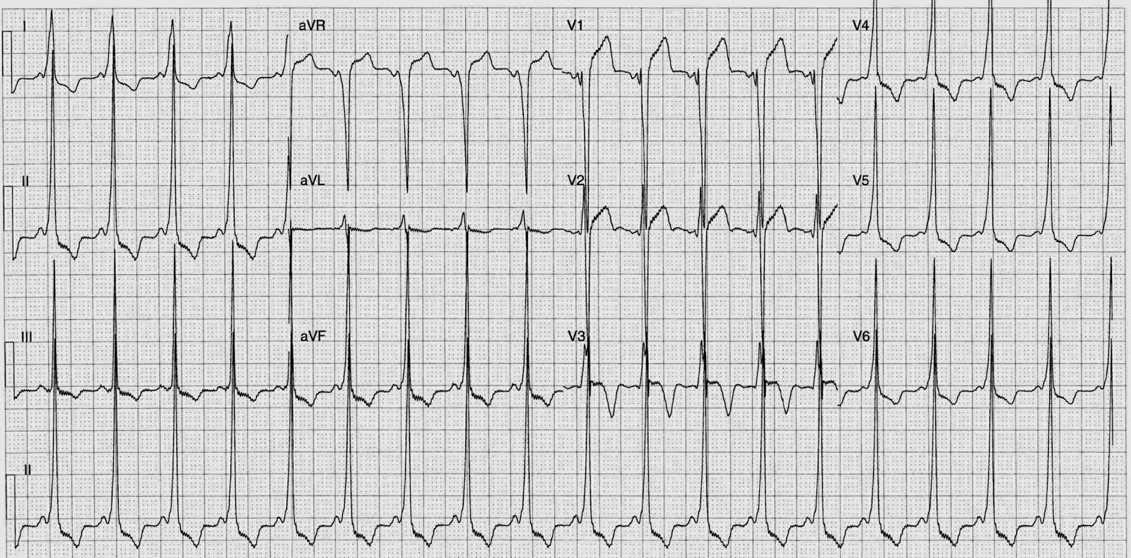 ECG of the Week: ECG of the Week - 7th April 2014 - Interpretation
