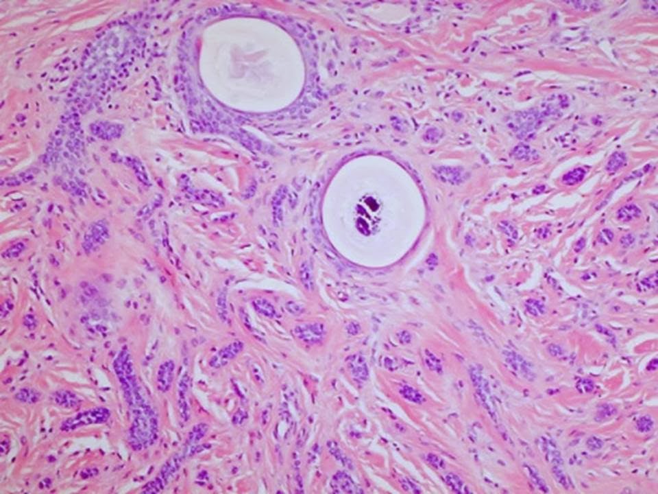 Differential Diagnosis in Dermatopathology: Desmoplasia