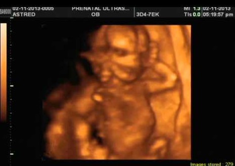 17 weeks Pregnant symptoms, Belly, Ultrasound and With Twins