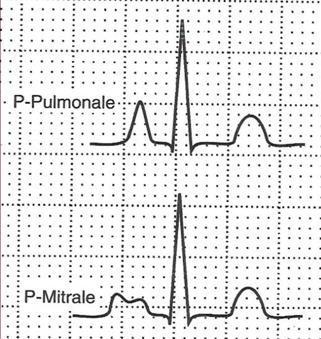 Phimaimedicine: 1,693 ข้อควรทราบเรื่อง EKG แบบ P pulmonale และ P mitrale