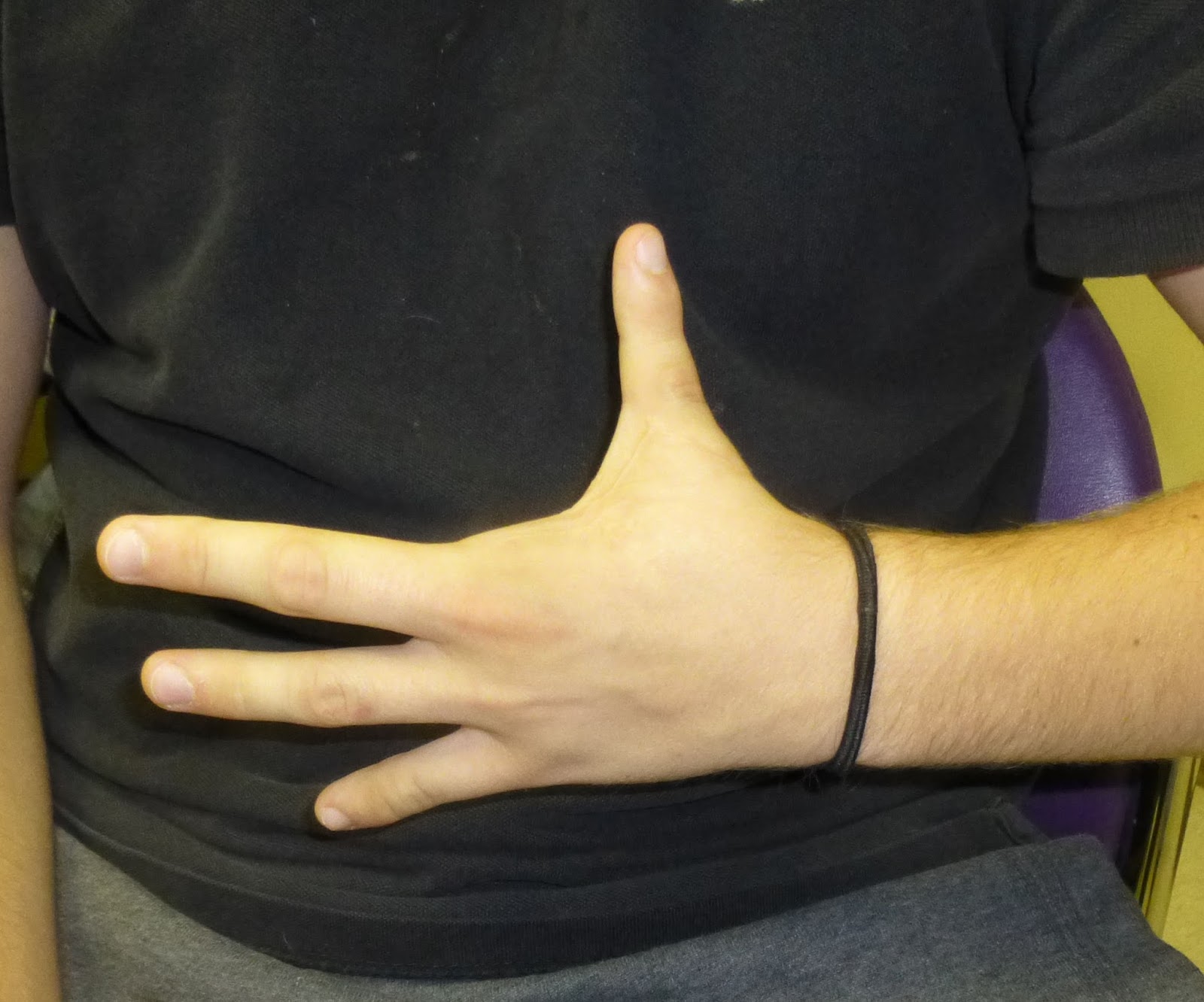 Pollicization at 15 years | Congenital Hand and Arm Differences ...