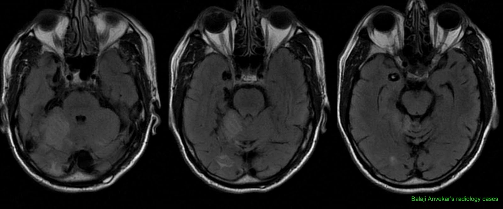 Dr Balaji Anvekar FRCR: Dural AV Malformation / Fistula MRI