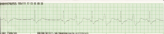 EKG Rhythm Strips 18: Ventricular Ectopy 1