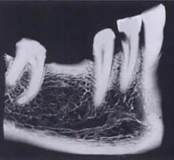 SEMINARIO Nº13: Prótesis I: Evaluación del diente pilar y áreas ...