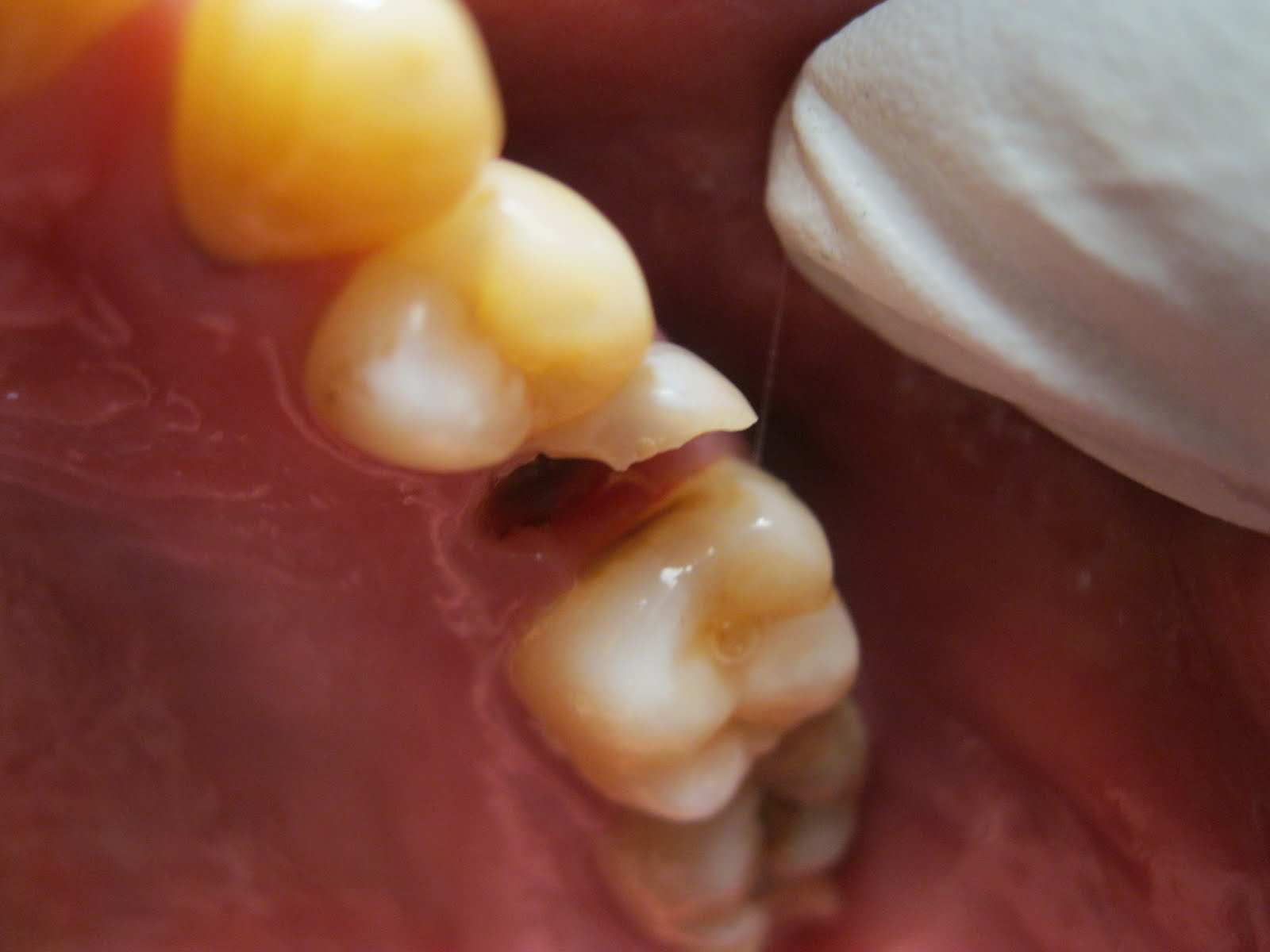 DENTO CARE DENTAL CLINICS: Post And Core-Restoration Of Extraction ...