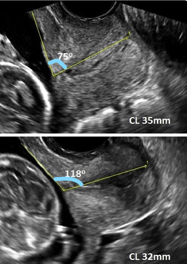 Ob/Gyn Updated : A novel ultrasound parameter help predicts mid ...