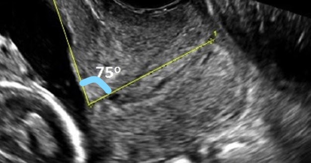 Ob/Gyn Updated : A novel ultrasound parameter help predicts mid ...