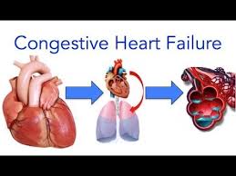 NCP for Congestive Heart Failure (CHF) - Nursing Diagnosis : Activity ...