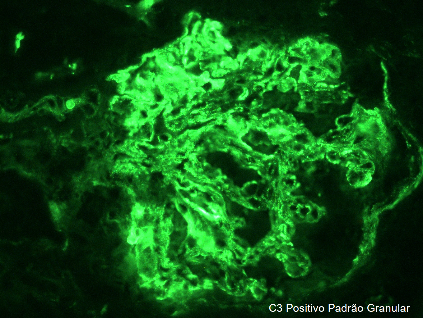 LABORATÓRIO CEAP: Nefrite Lúpica