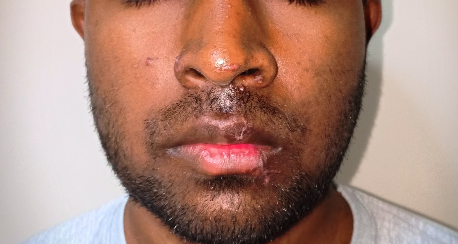 VIDHUNS PLASTIC SURGERY AND COSMETIC WORLD: ACUTE LIP LOSS ...